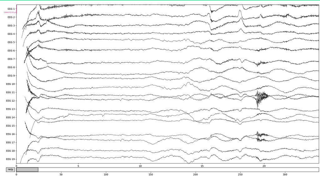 Scaling issue while plotting EEG signal - 💬 Support & Discussions - MNE ... Scaling issue while plotting EEG signal - 💬 Support & Discussions - MNE ...