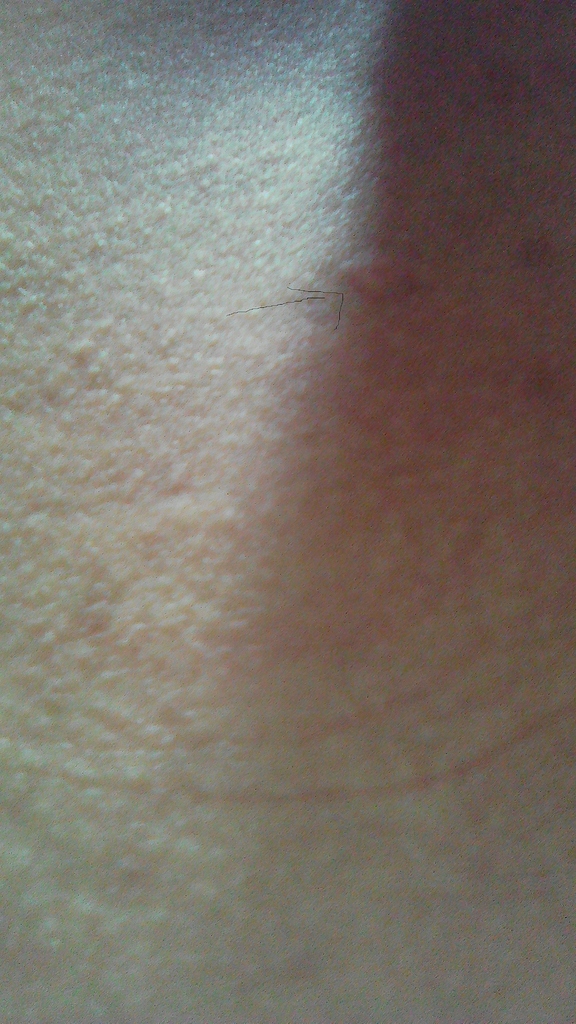 Is this injection mark? - Unusual Beliefs - Schizophrenia.com
