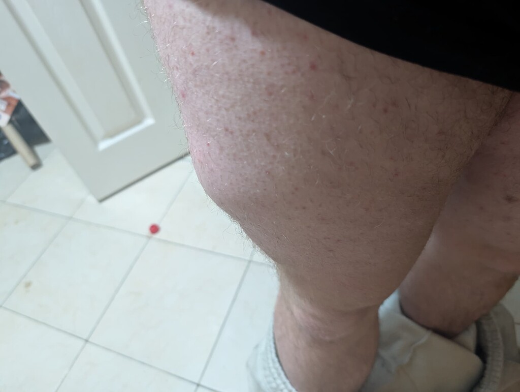 Post injection swelling - Pharma / TRT - T NATION