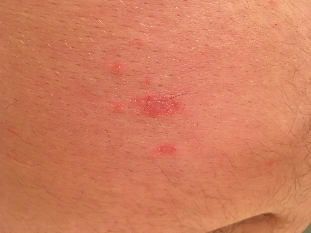 Is This HCG Rash? - Testosterone Replacement - T NATION