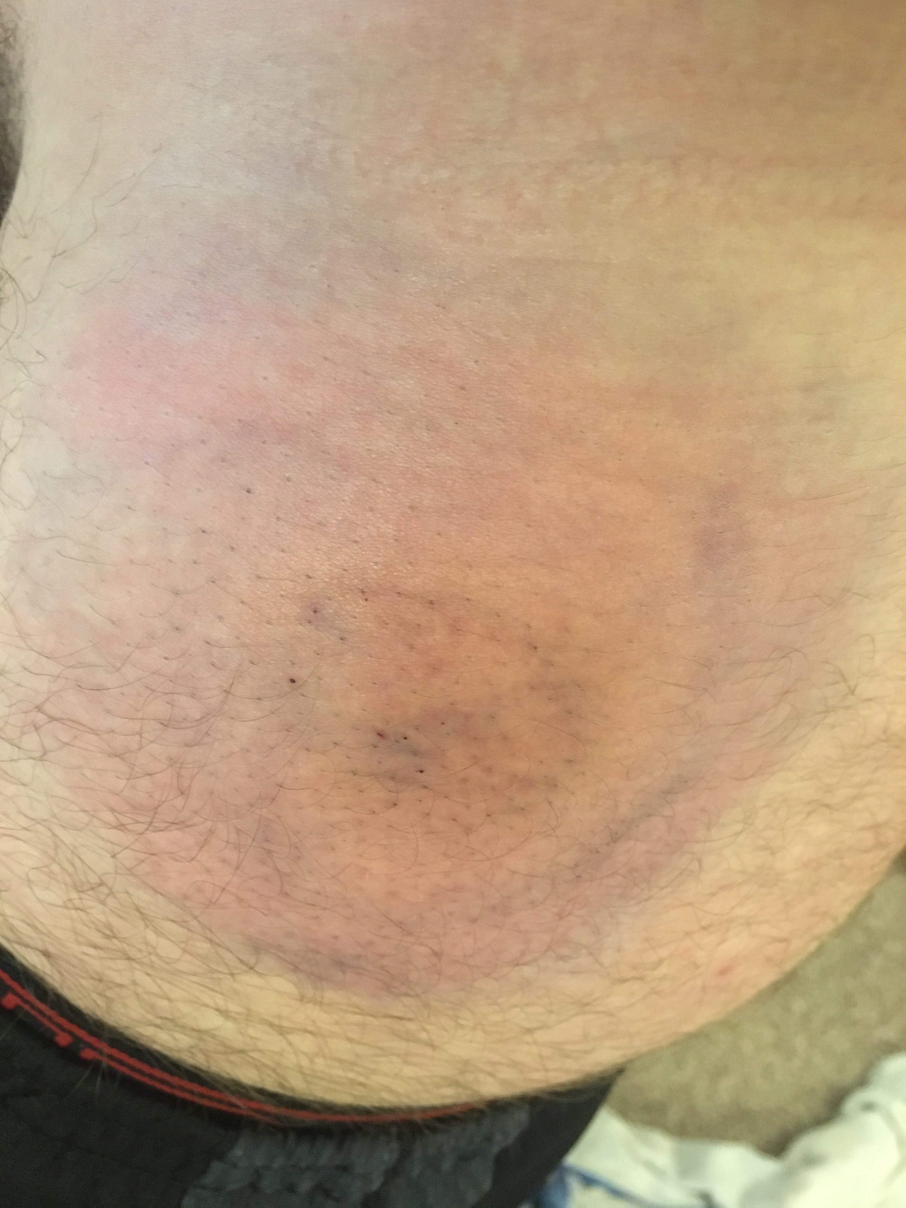 Bad Gear or Injection Site Infection? - Pharma / TRT - T NATION