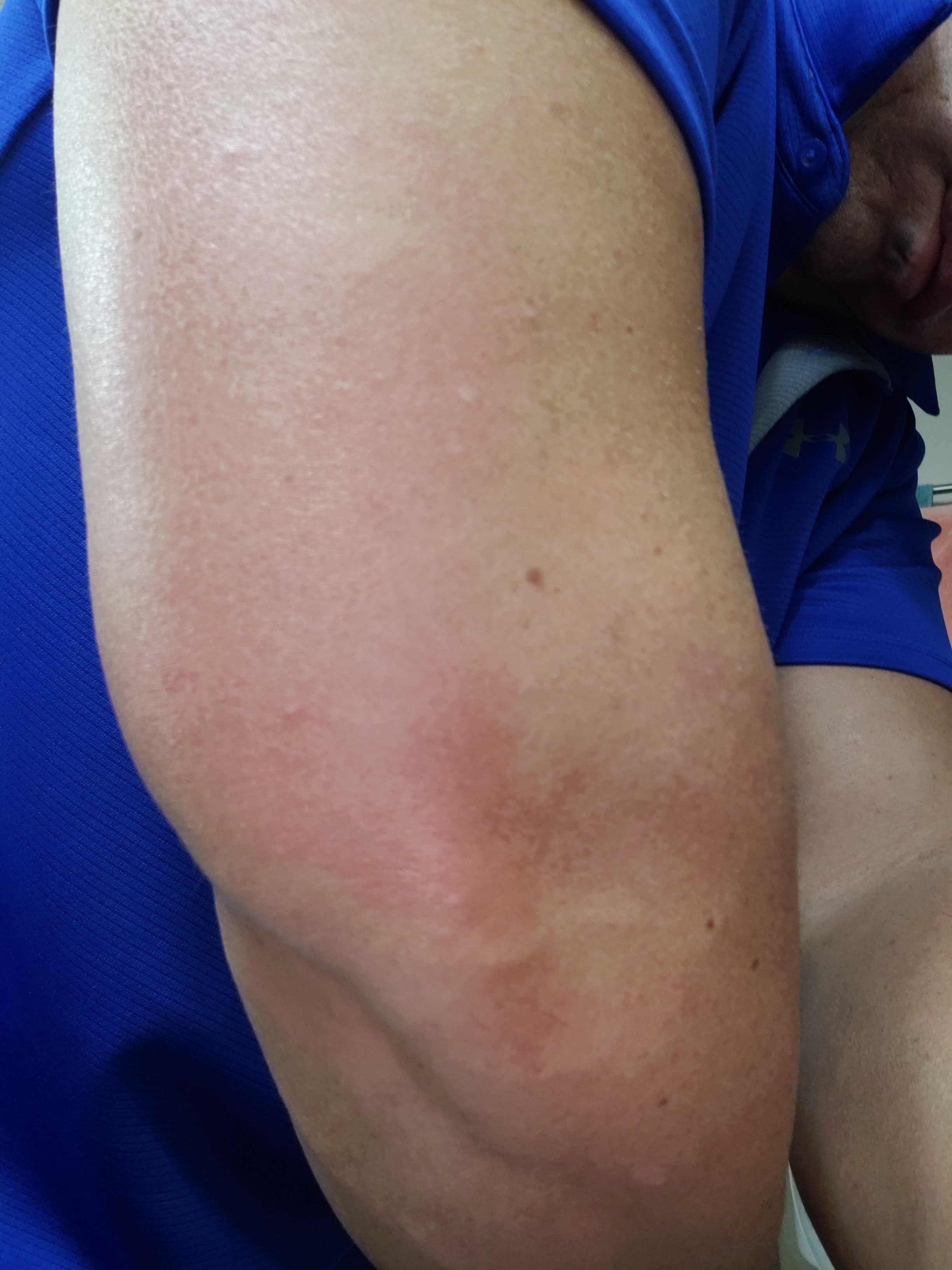 Swelling After Injections - Pharma / TRT - T NATION