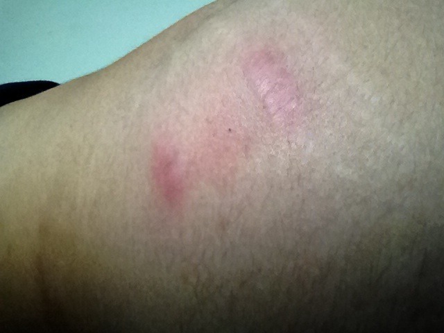 Lump on Glutes after Injection - Pharma / TRT - T NATION