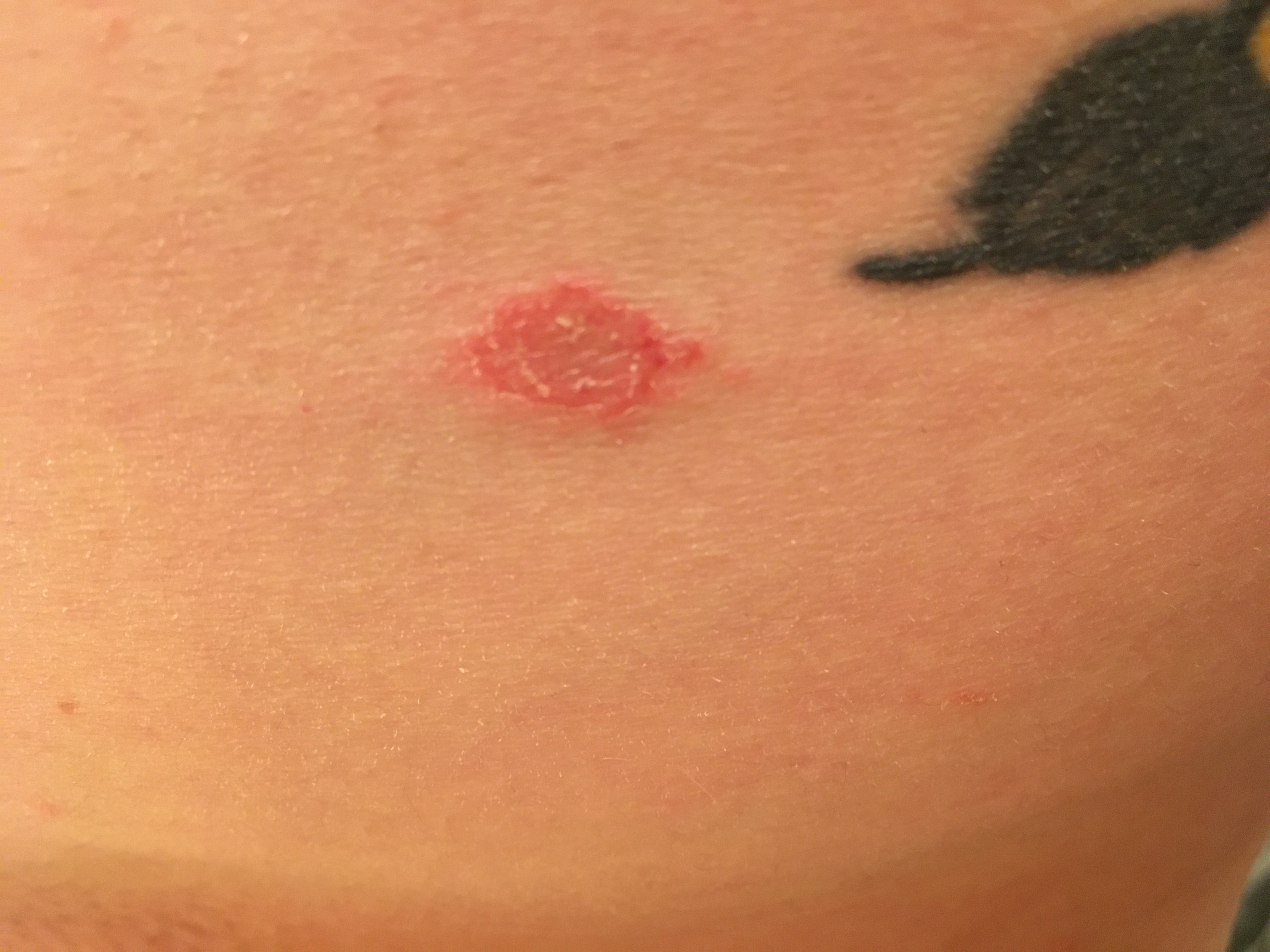 Is This HCG Rash? - Testosterone Replacement - T NATION