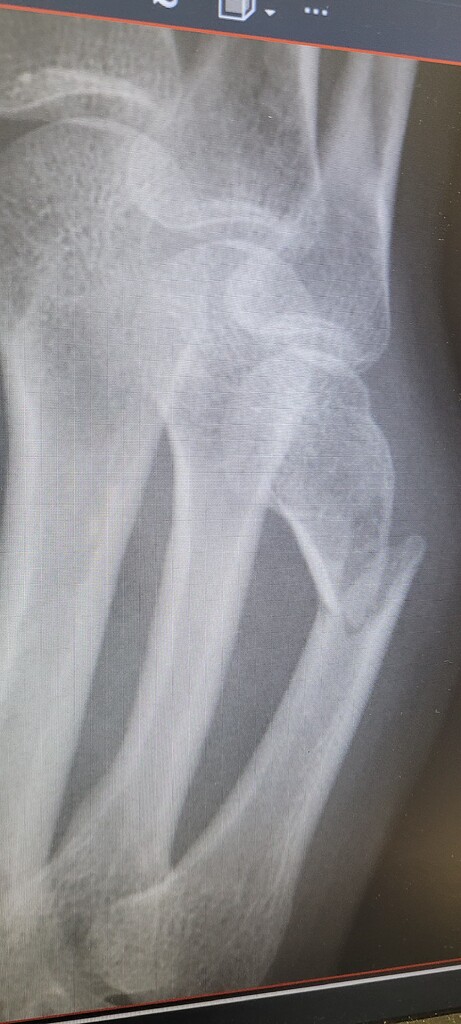 Training and recovery with a hand in cast - Training - TrainerRoad